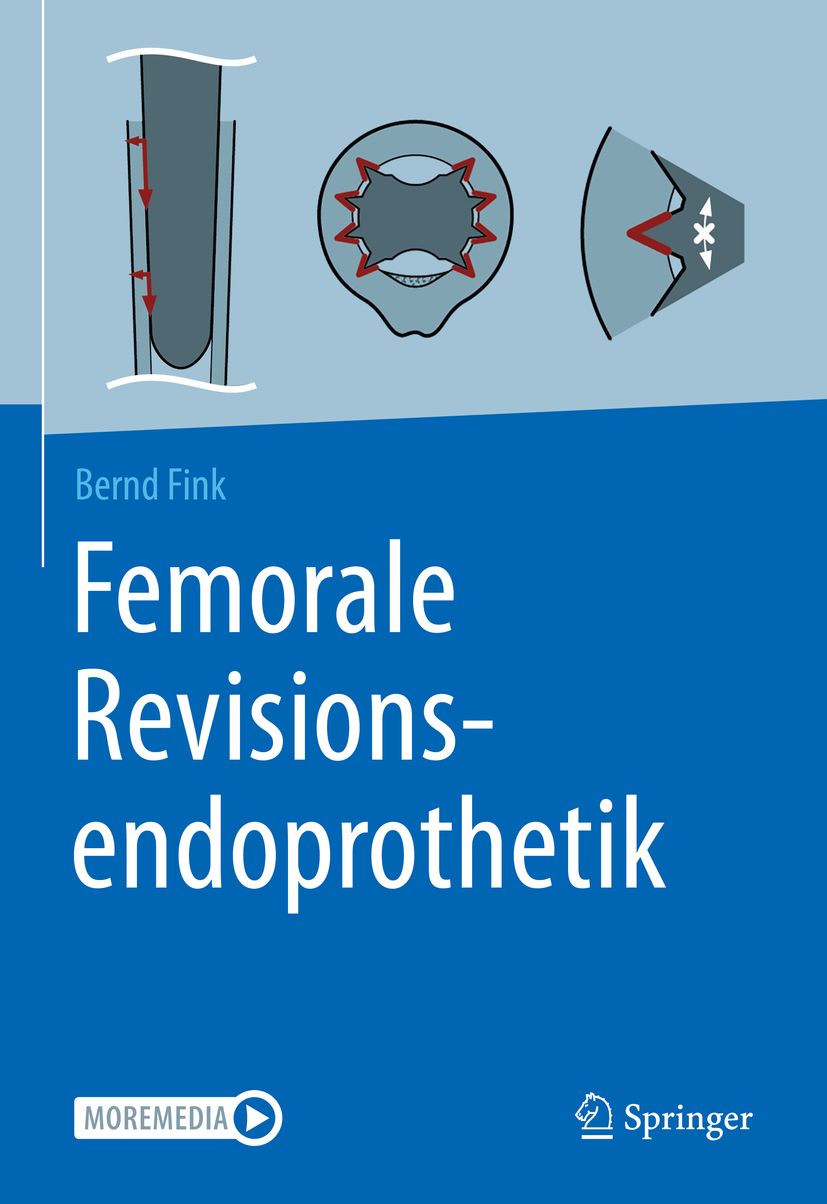 Femorale Revisionsendoprothetik 1 St - Shop Apotheke